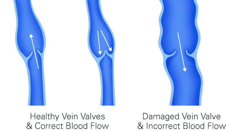 Les varices – Cabinet de Médecine vasculaire